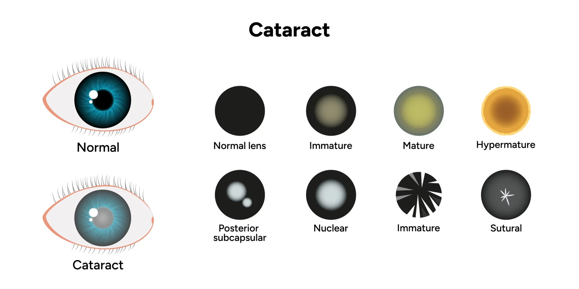 Cataract Surgery Process Cataract Surgery | Private Cataract Removal